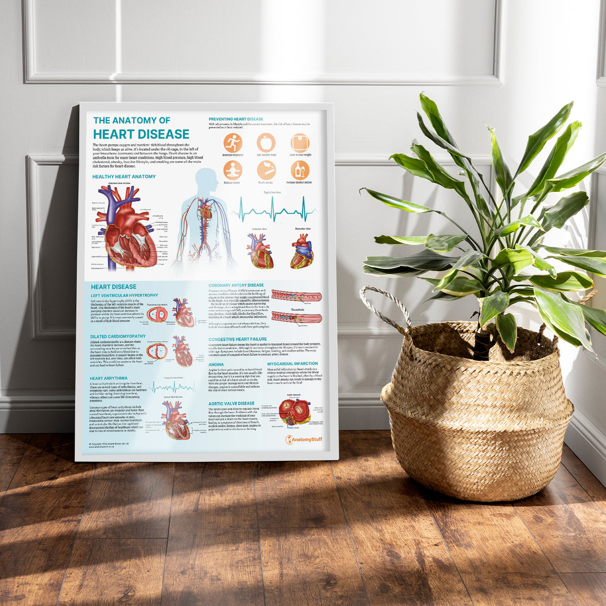 The Anatomy of Heart Disease Chart/Poster Laminated | Cardiovascular ...