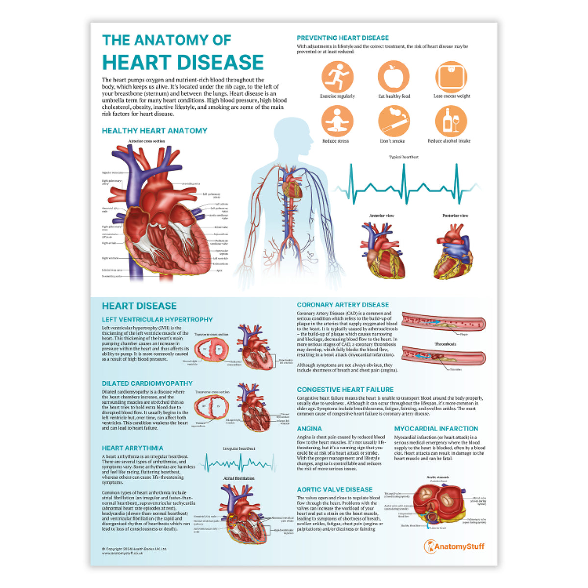 The Anatomy of Heart Disease Chart/Poster Laminated | Cardiovascular ...