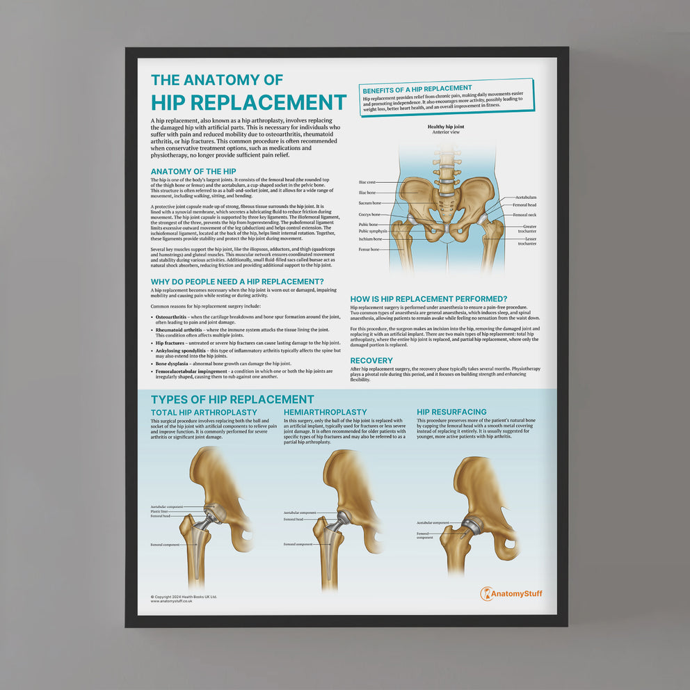 The Anatomy of Hip Replacement | Knee Replacement Chart – AnatomyStuff