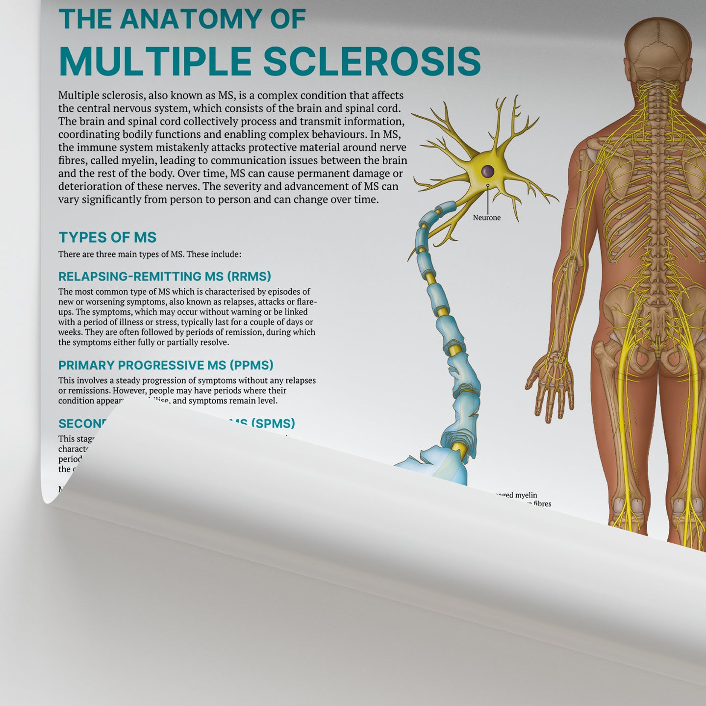 The Anatomy of Multiple Sclerosis Chart / Poster - | AnatomyStuff