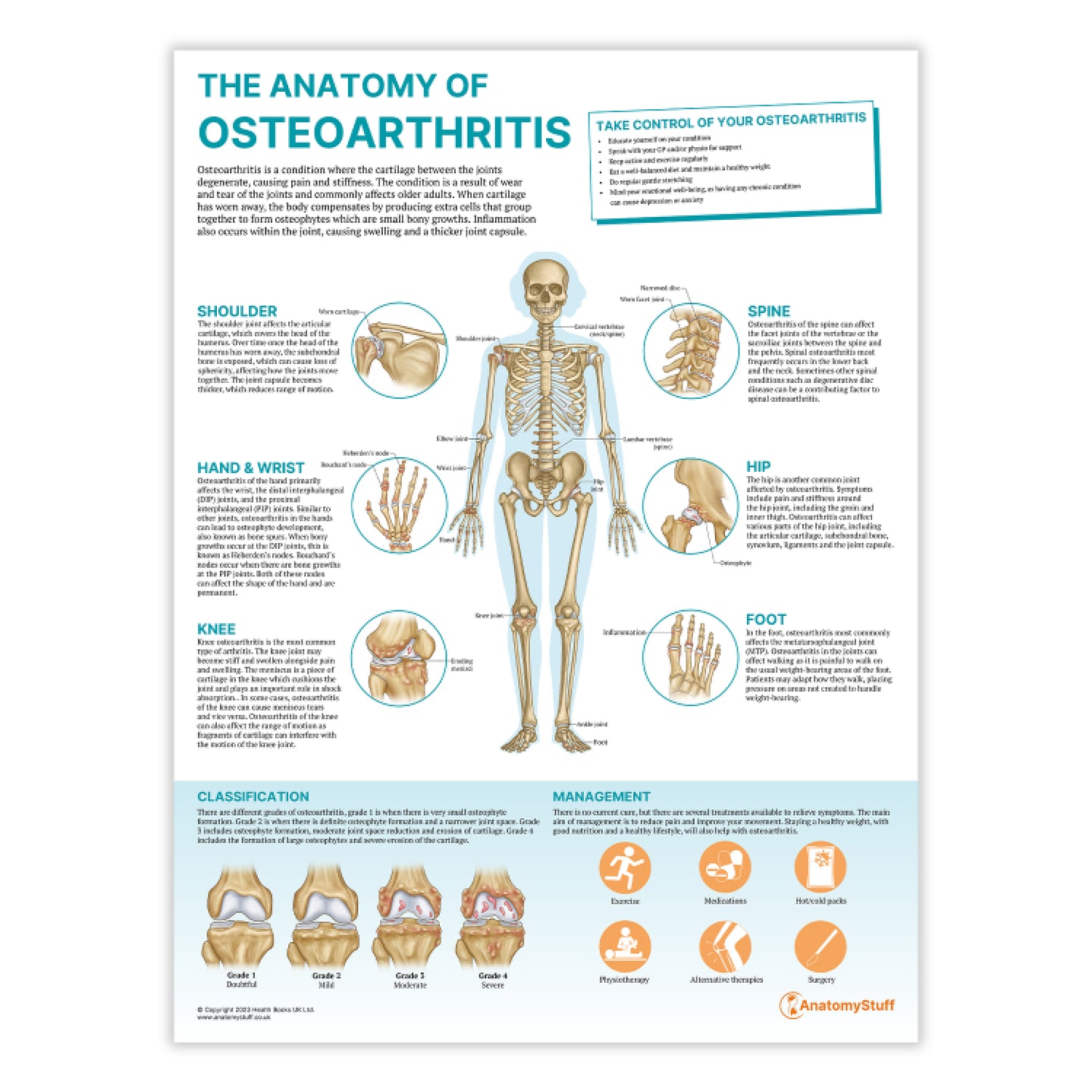 Osteoarthritis (OA) Education Collection | Degeneration Joints Charts ...