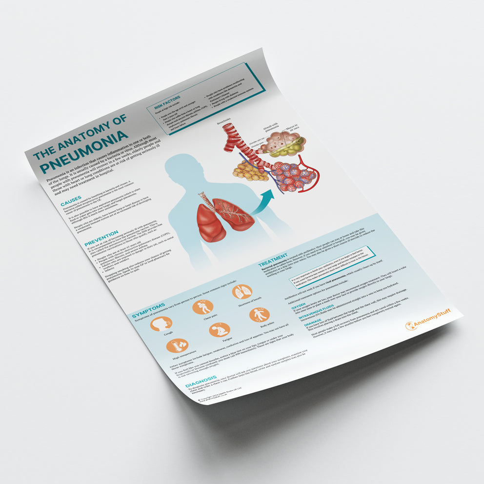 The Anatomy of Pneumonia Chart/Poster ‚Äì Laminated | Respiratory ...