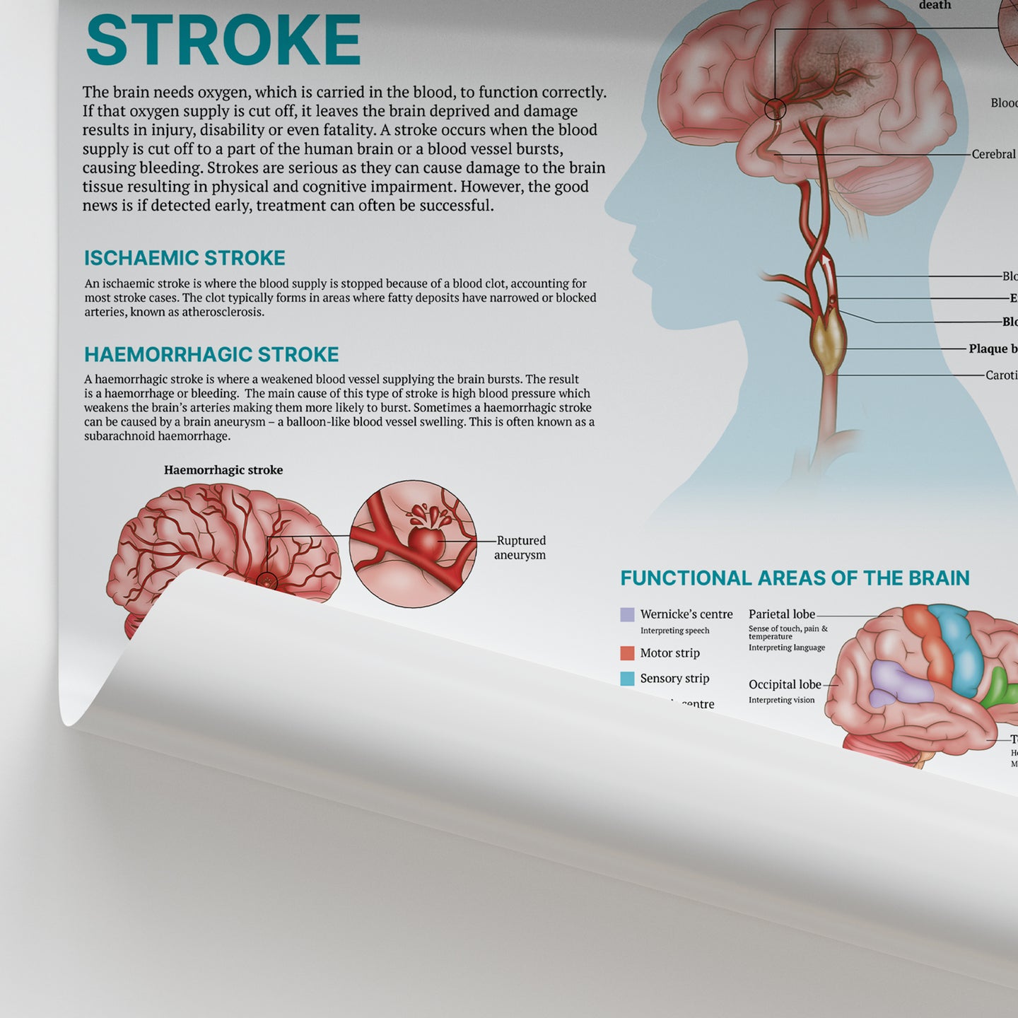 The Anatomy of Stroke | Neuro Pathology Education | AnatomyStuff