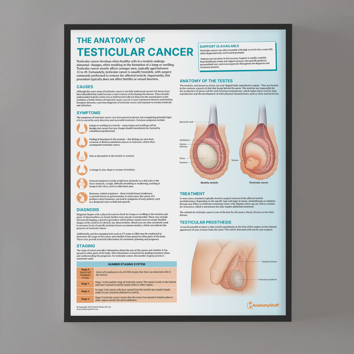 The Anatomy of Testicular Cancer Chart / Poster - | AnatomyStuff