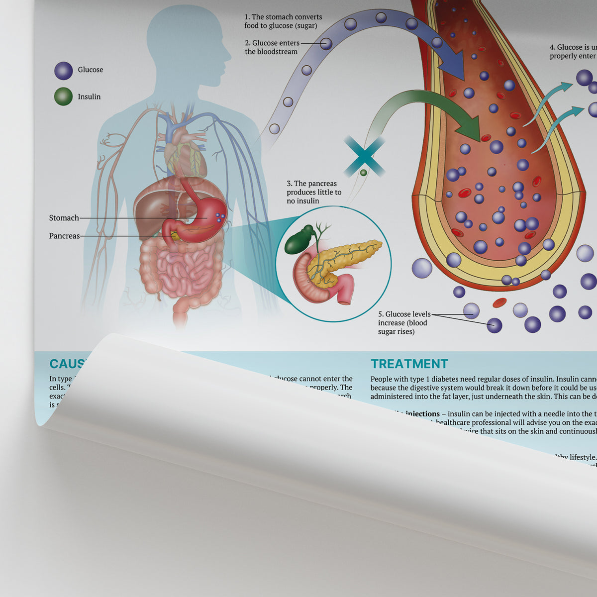 The Anatomy of Type 1 Diabetes Chart/Poster Laminated | Endocrine ...
